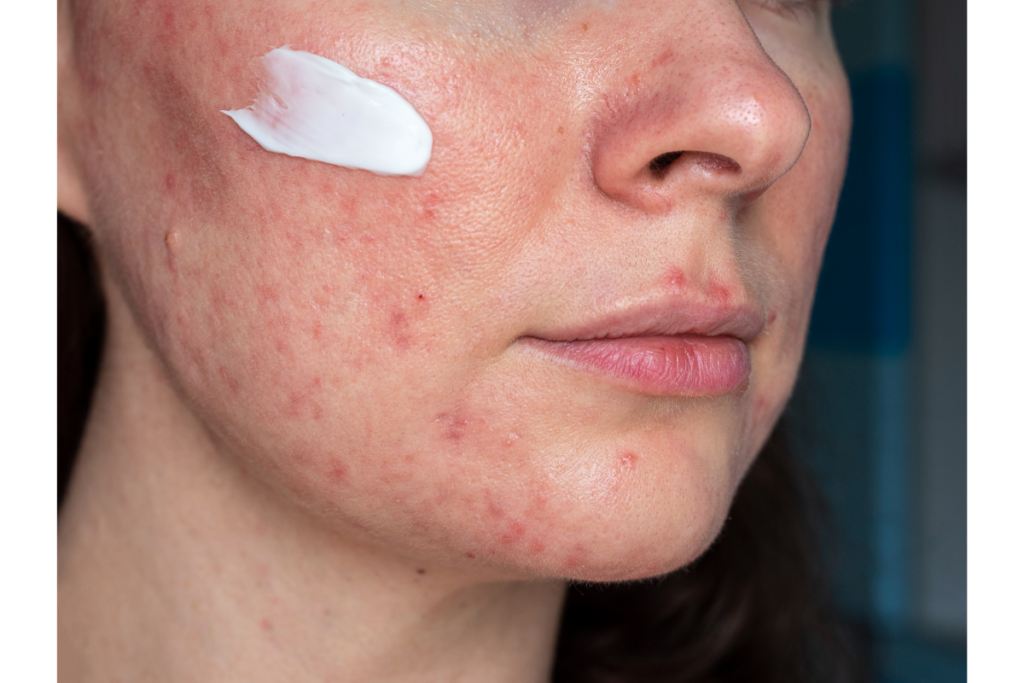 Rosacea: Understanding this skin disease
