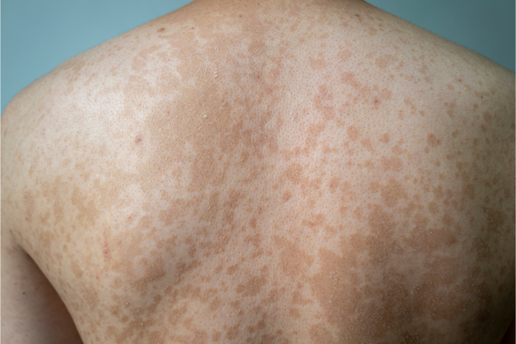 Pitiriasis versicolor: Tratamientos naturales que funcionan