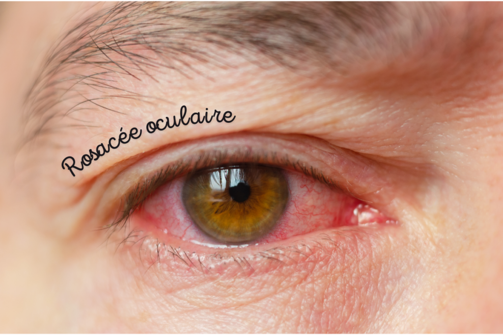 Tratamiento de la rosácea ocular